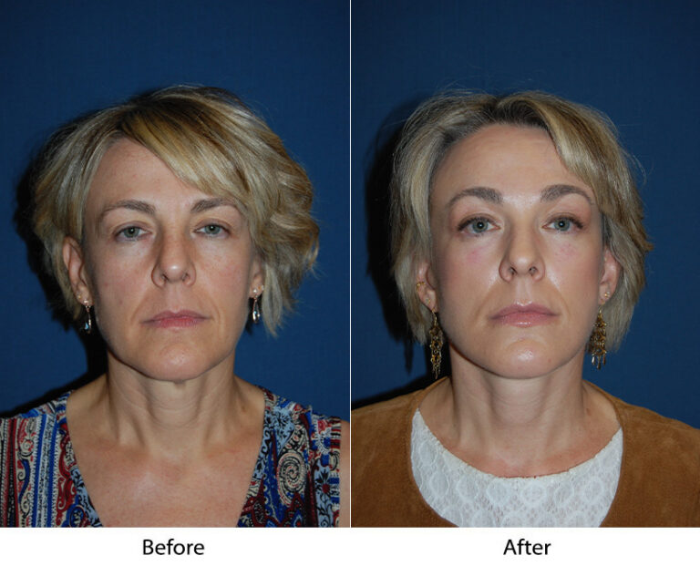 Aggressive Lateral Brow Lift by Charlotte's Top Facial Surgeon