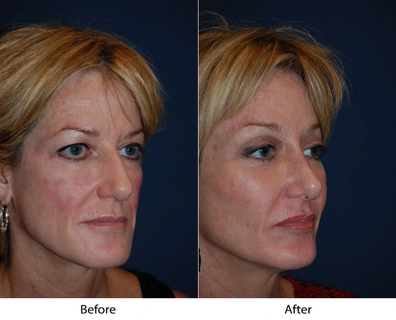 Best Cheek Implants in Charlotte, NC | Cheek Augmentation